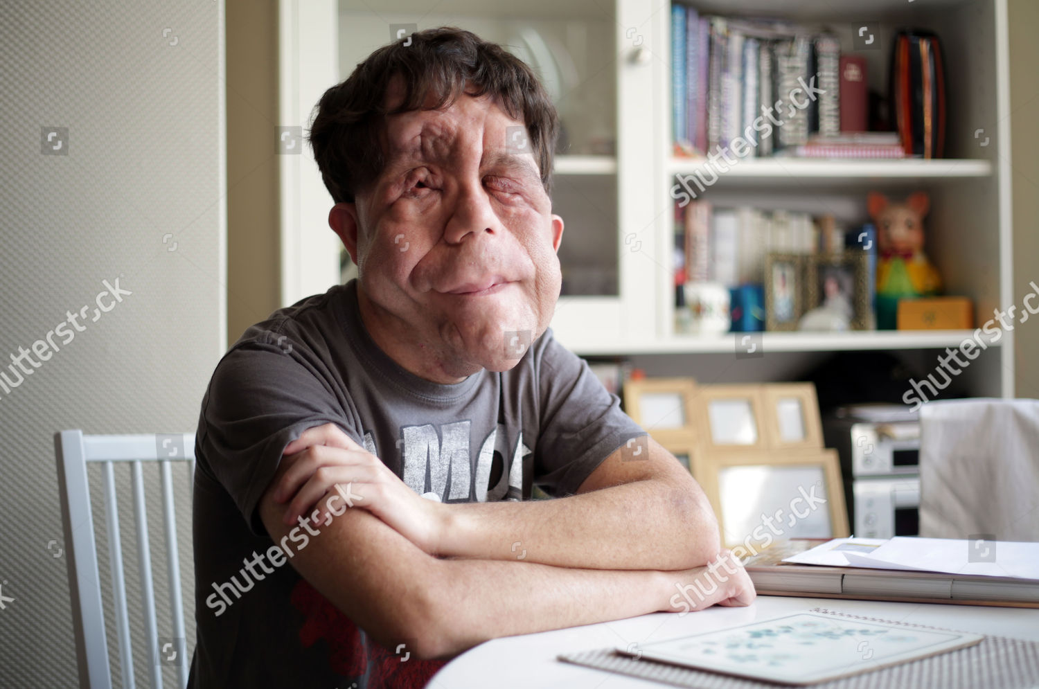 Adam Pearson Who Lives Neurofibromatosis Which Editorial Stock Photo ...