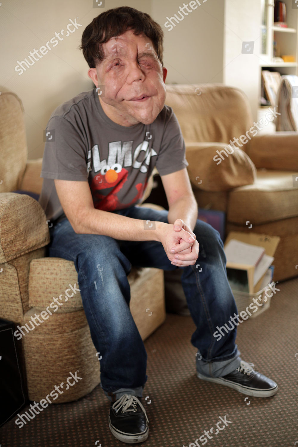 Adam Pearson Who Lives Neurofibromatosis Which Editorial Stock Photo ...