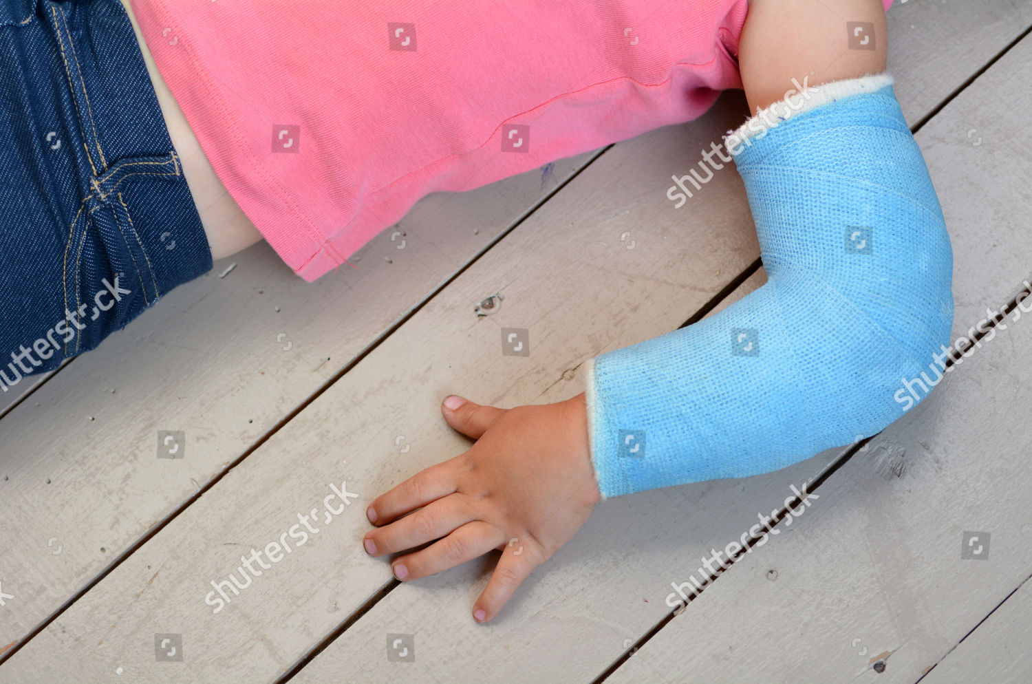 Child Broken Arm Wearing Cast Editorial Stock Photo - Stock Image ...