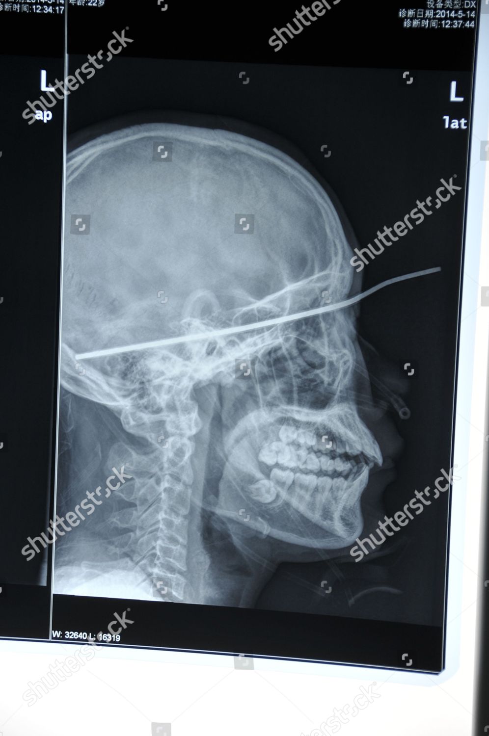 Xray Showing Rod Impaled Ha Weis Editorial Stock Photo - Stock Image ...