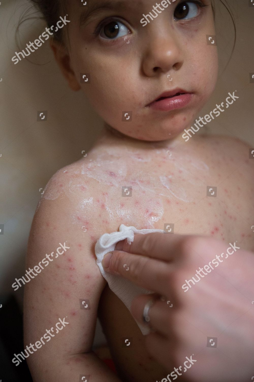 Child Chickenpox Editorial Stock Photo - Stock Image | Shutterstock