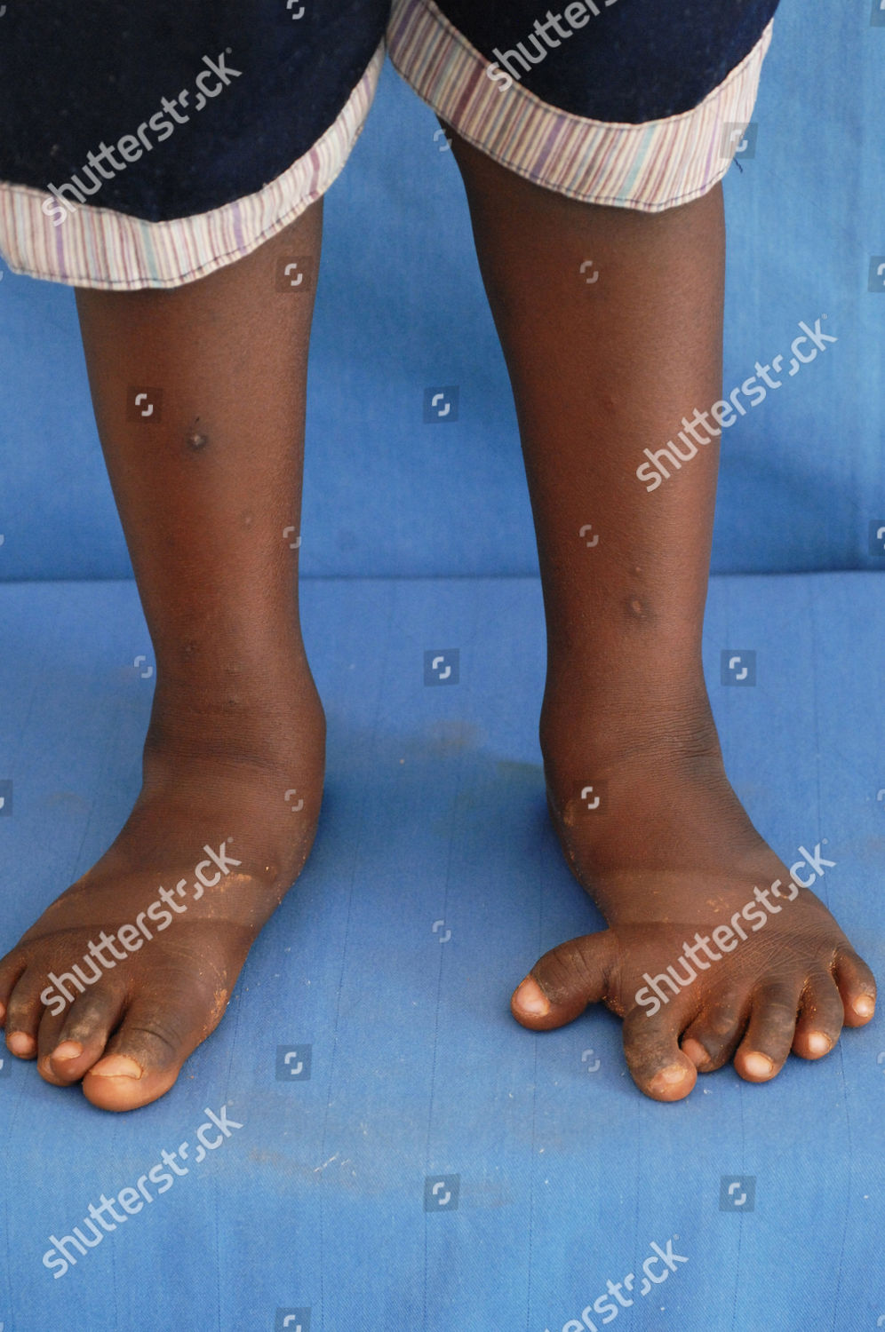 Patient Has Congenital Deformity Extra Toe Editorial Stock Photo ...