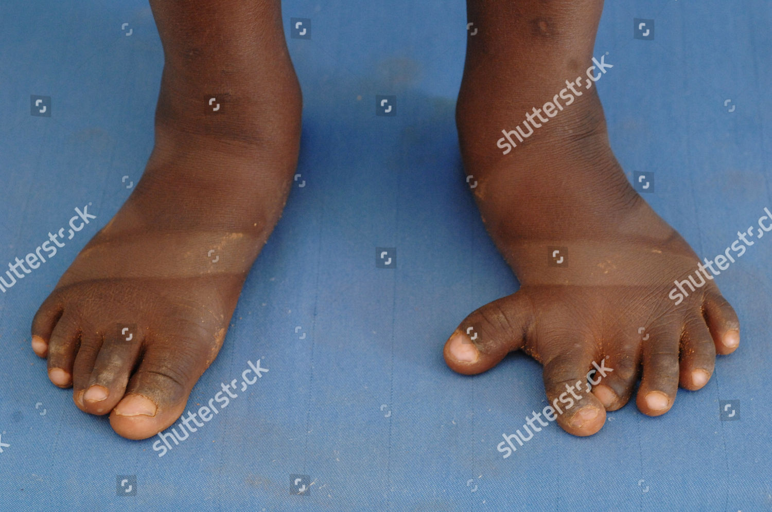 Patient Has Congenital Deformity Extra Toe Editorial Stock Photo ...