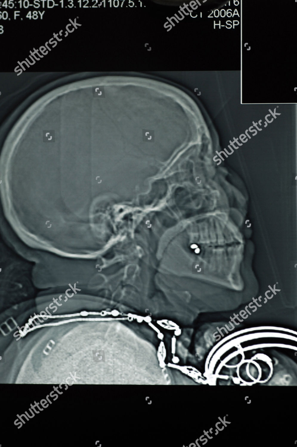 Ct Scan Skull Editorial Stock Photo - Stock Image | Shutterstock