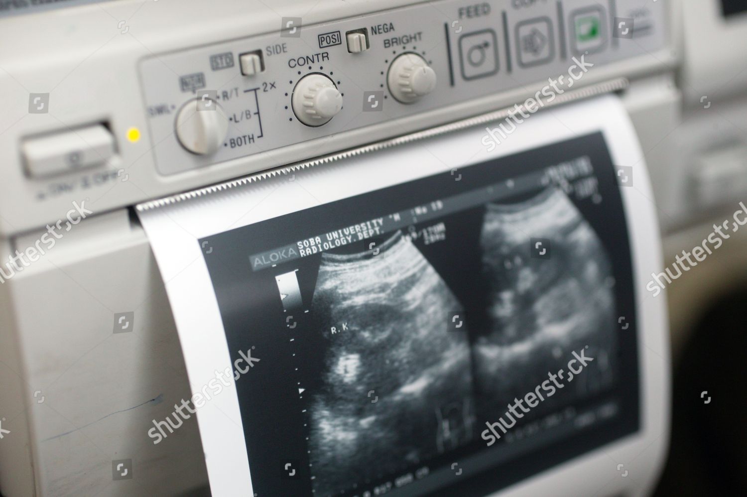Print Out Ultrasound Recording Showing Abdominal Editorial Stock Photo ...