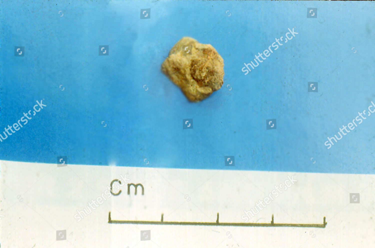 Gallstone Produced By Bile Gallbladder There Editorial Stock Photo ...