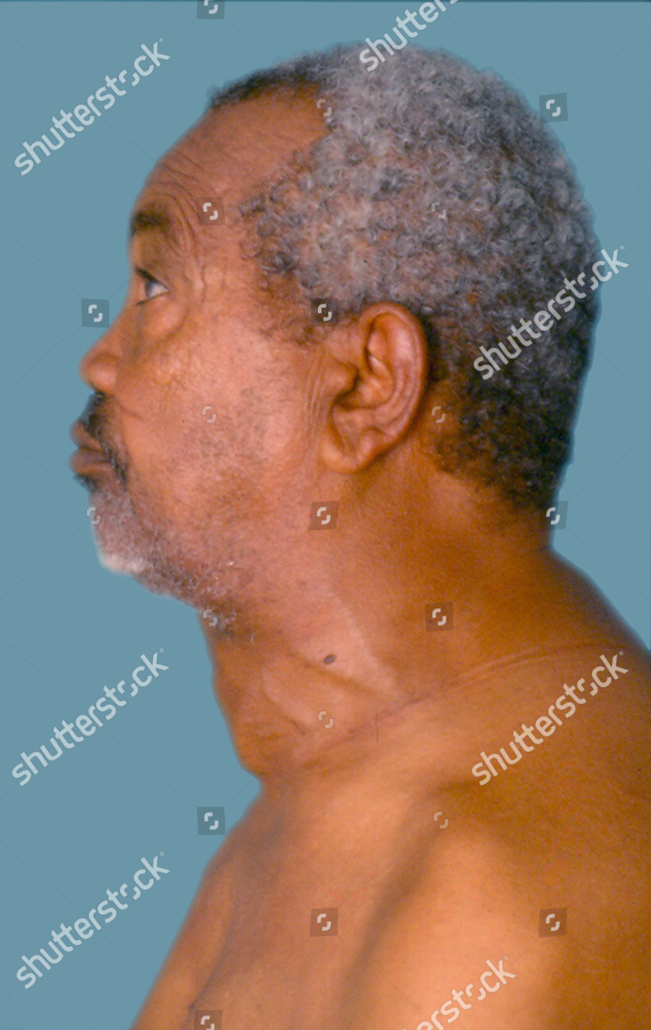 Patient Has Multinodular Goitre Swelling Neck Editorial Stock Photo ...
