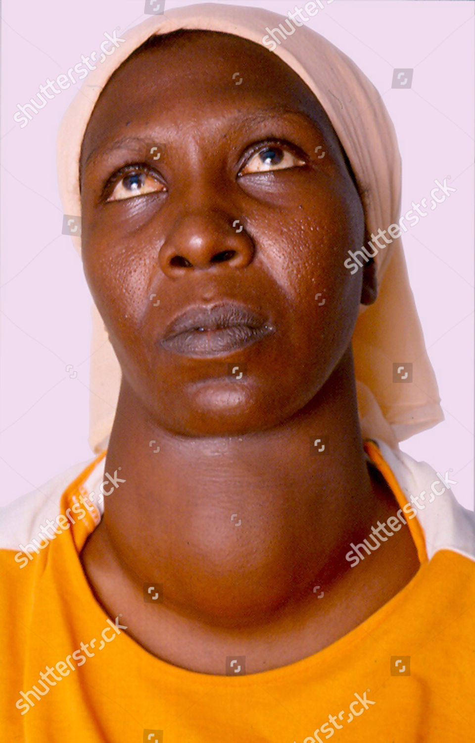PATIENT HAS MULTINODULAR GOITRE SWELLING NECK Editorial Stock Photo ...