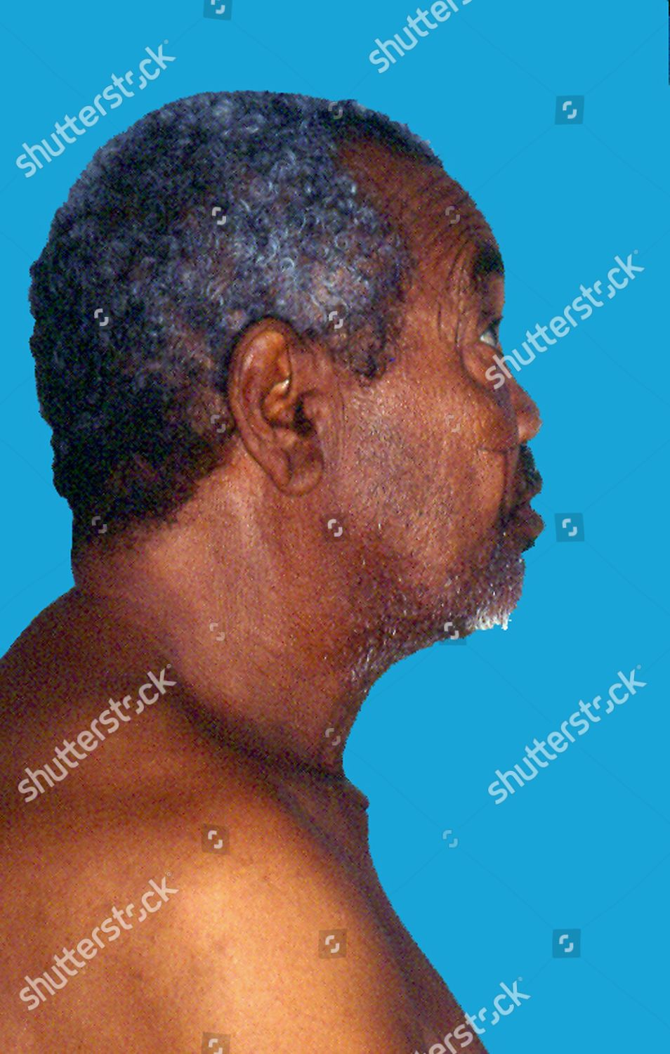 Patient Has Multinodular Goitre Swelling Neck Editorial Stock Photo ...