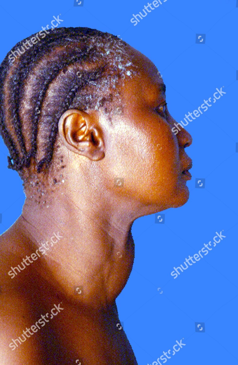Patient Has Multinodular Goitre Swelling Neck Editorial Stock Photo ...