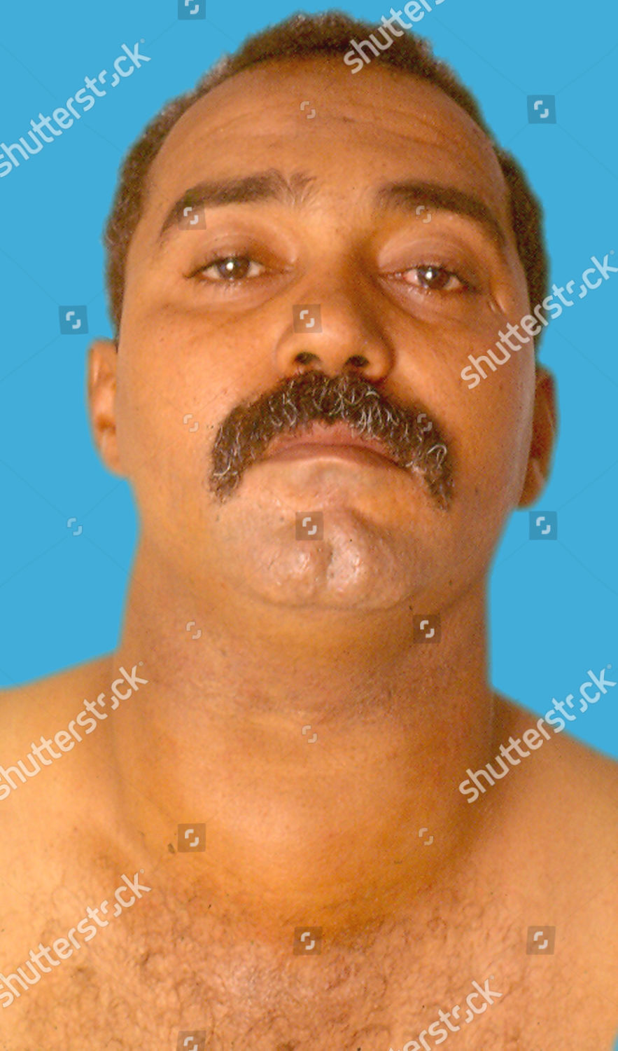 Patient Has Multinodular Goitre Swelling Neck Editorial Stock Photo ...