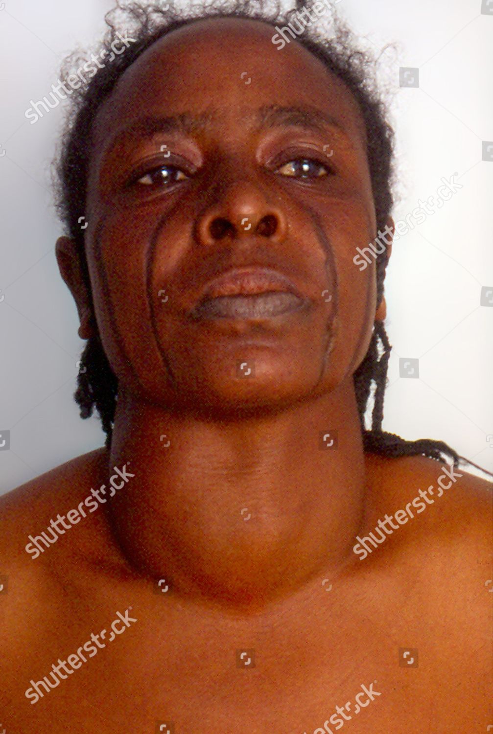 PATIENT HAS MULTINODULAR GOITRE SWELLING NECK Editorial Stock Photo ...