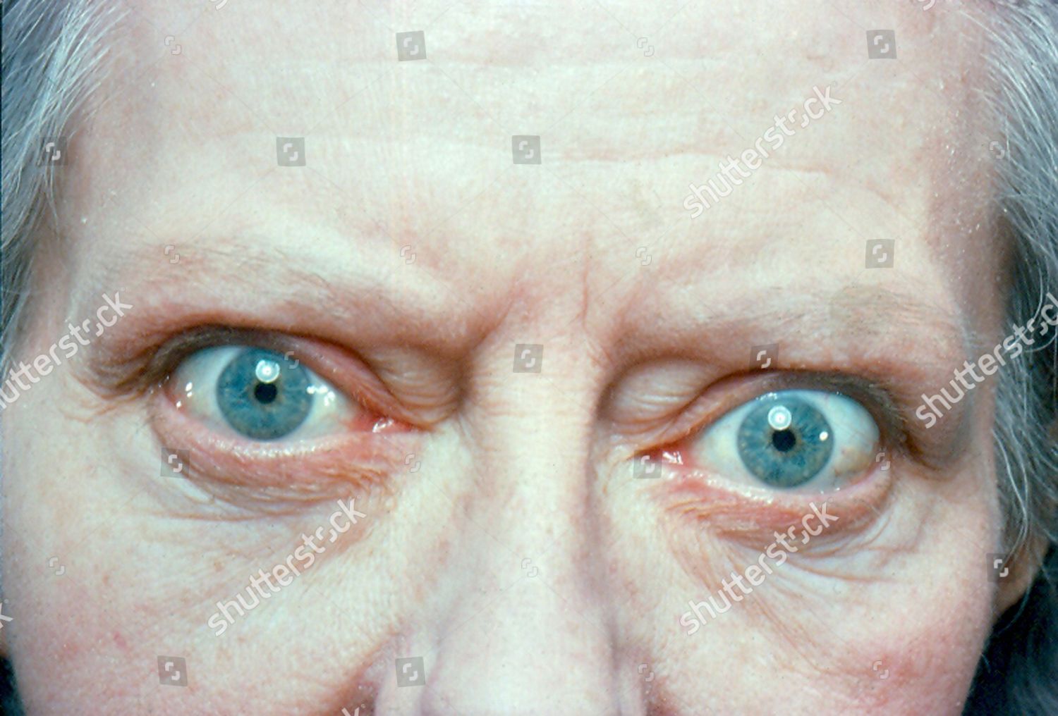 Woman Abnormal Eye Signs Toxic Goitre Editorial Stock Photo - Stock ...