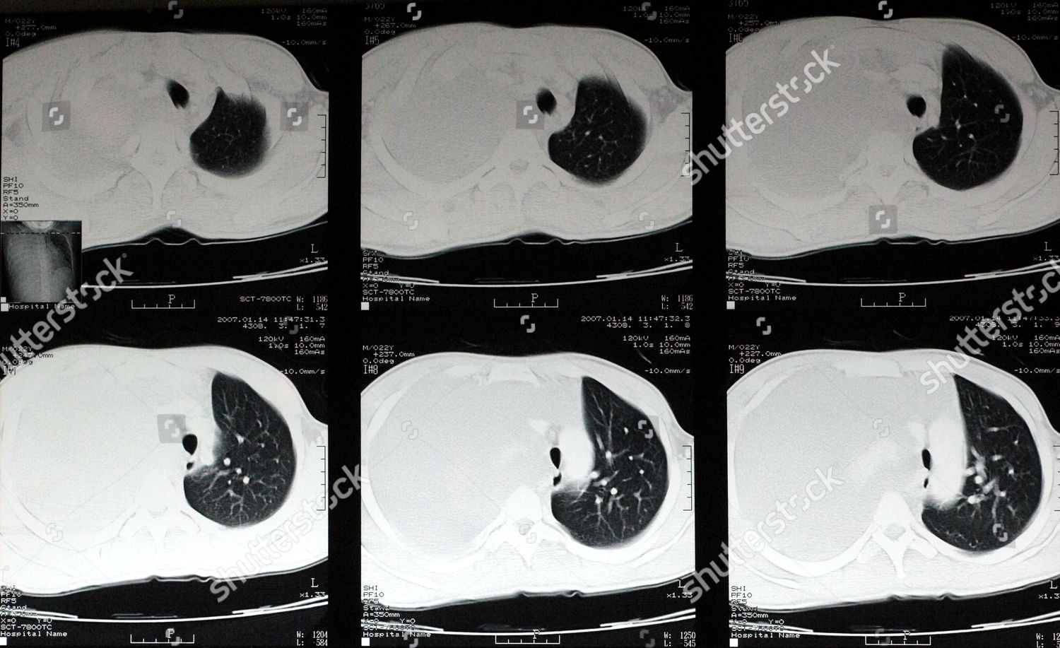 Model Released Ct Scan Showing Massive Editorial Stock Photo - Stock ...