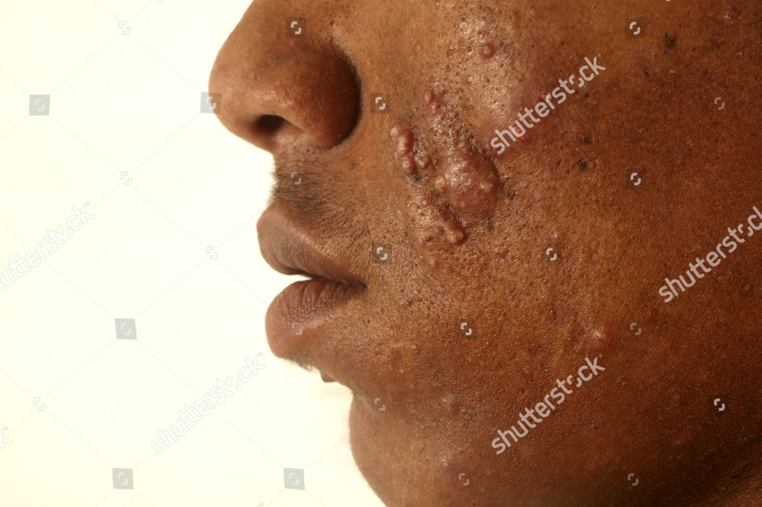 Side View Lower Half Face 21 Editorial Stock Photo - Stock Image ...