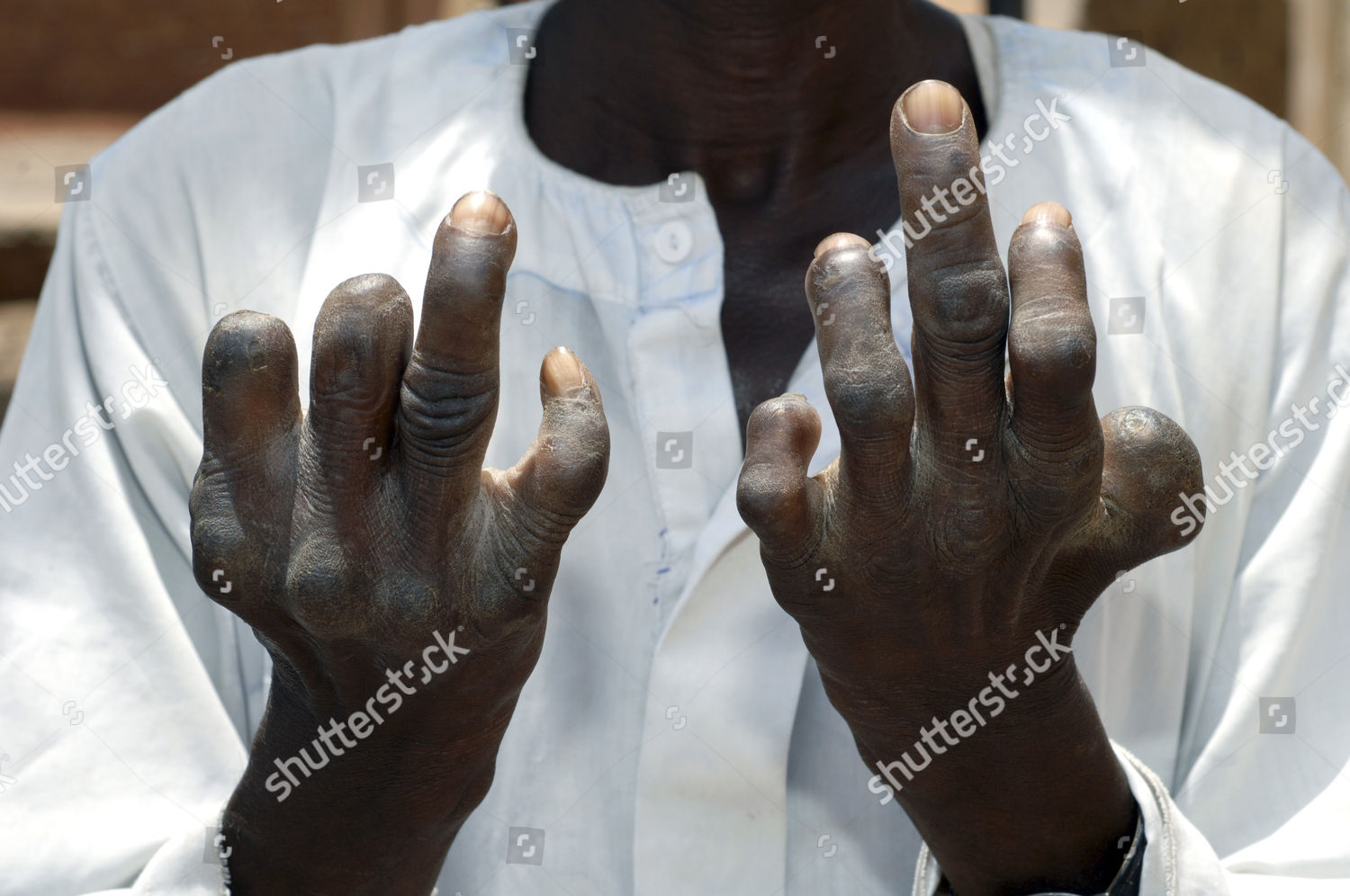 Elderly Male Leper Mutilated Hands Leprosy Editorial Stock Photo ...