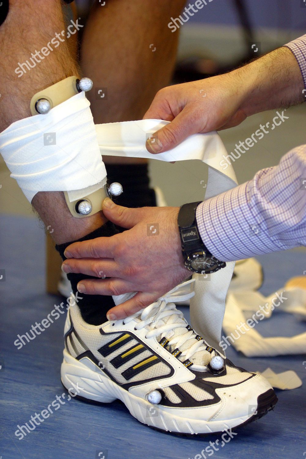 Measuring Fitting Foot Prosthesis Editorial Stock Photo - Stock Image ...