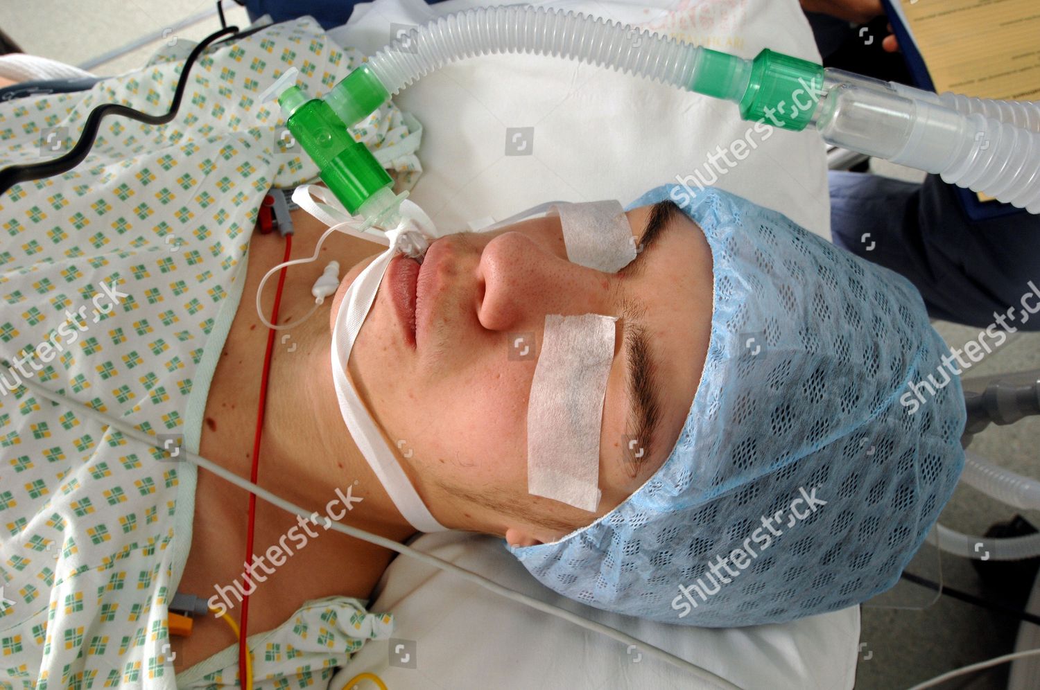 Close Anaesthetised Male Patient Tubes Mouth Editorial Stock Photo ...