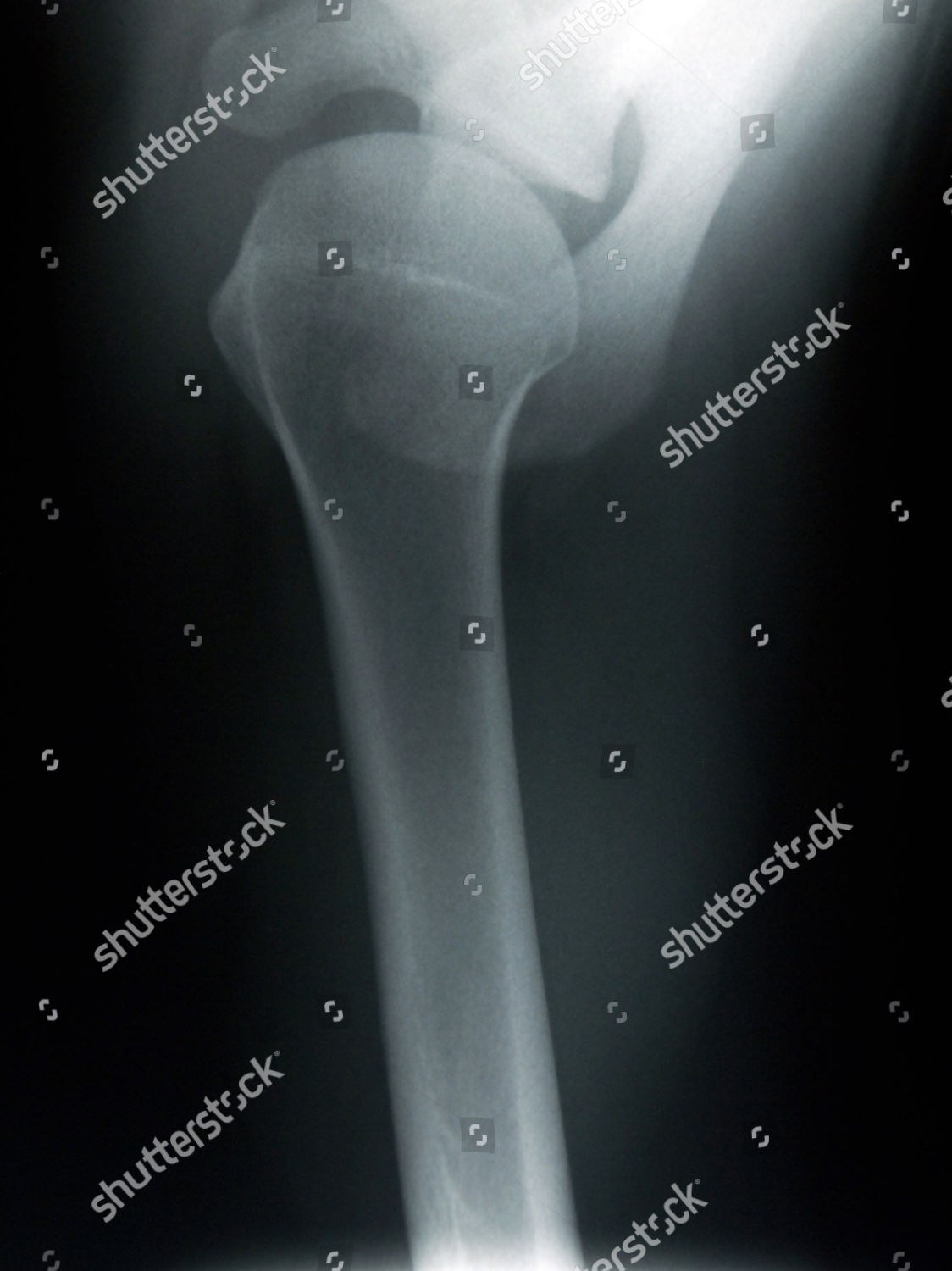 Xray Female Scapula Upper Humerous Editorial Stock Photo - Stock Image ...