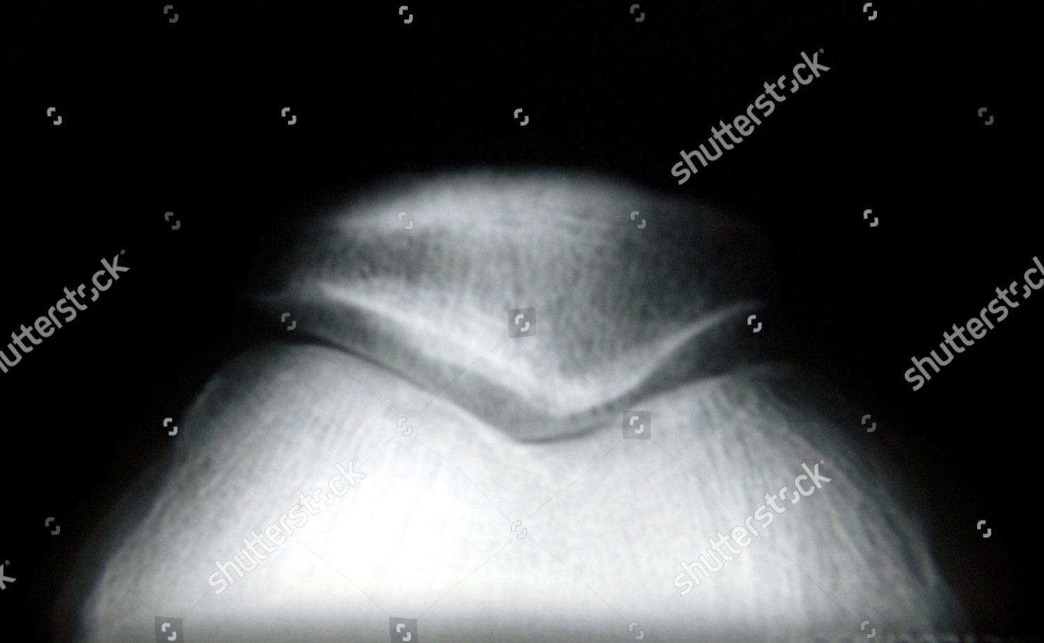 Xray Female Knee Joint Knee Cap Editorial Stock Photo - Stock Image ...