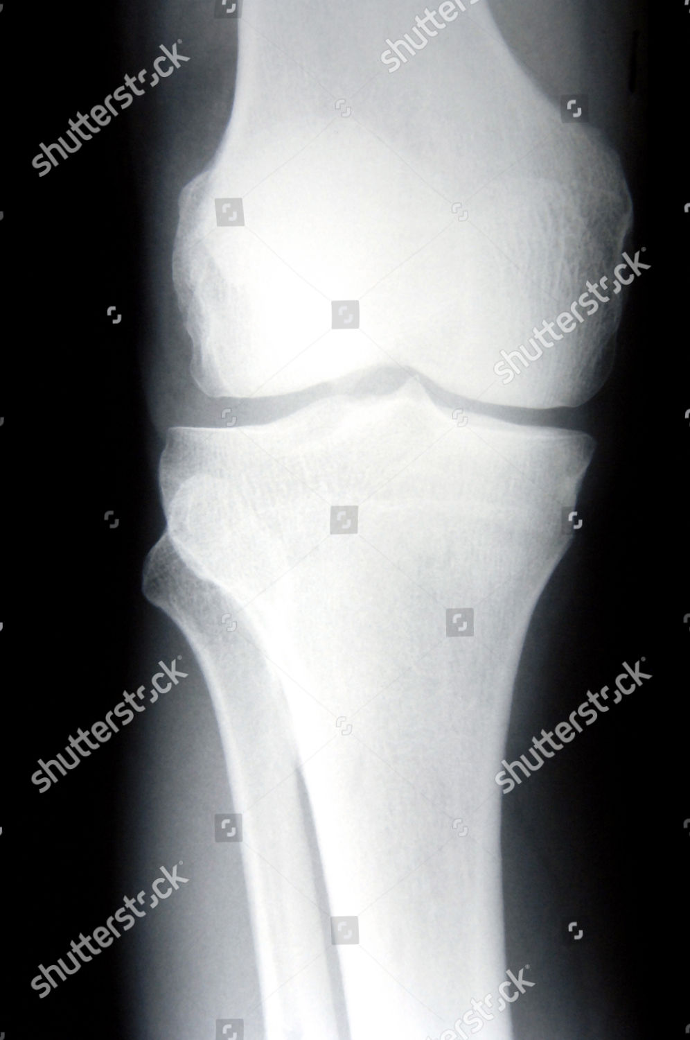 Xray Female Knee Joint Knee Cap Editorial Stock Photo - Stock Image ...