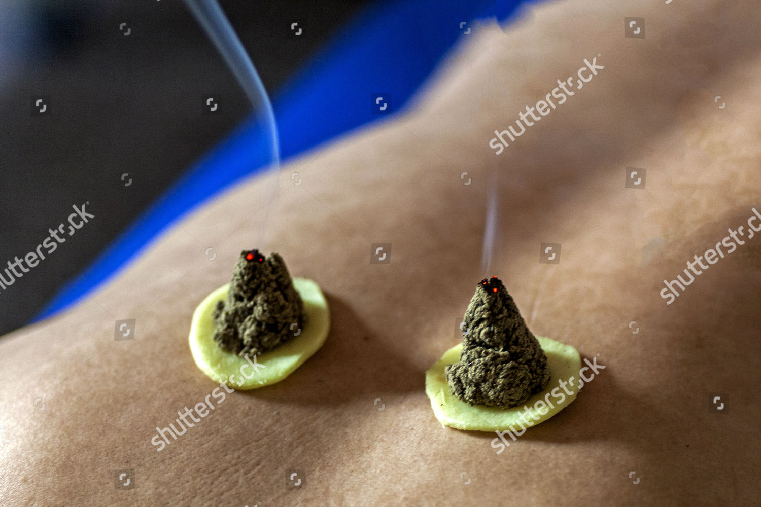 Man Doing Moxibustion On Ginger Therapy Editorial Stock Photo - Stock ...