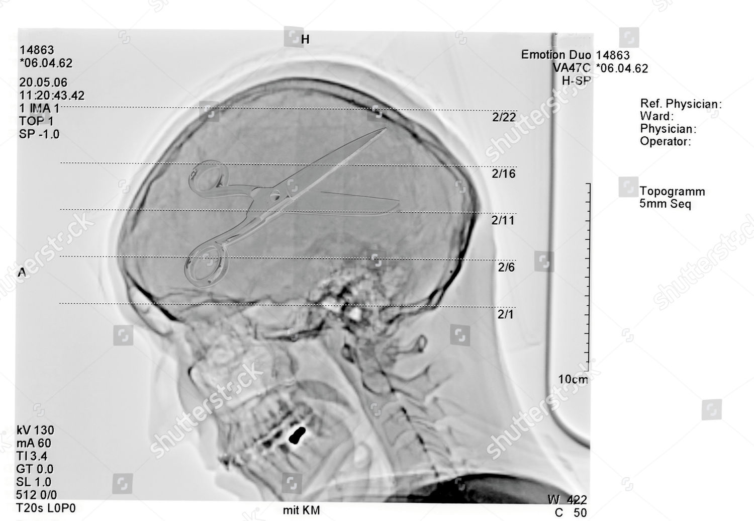 MODEL RELEASED X-RAY IMAGE Editorial Stock Photo - Stock Image ...