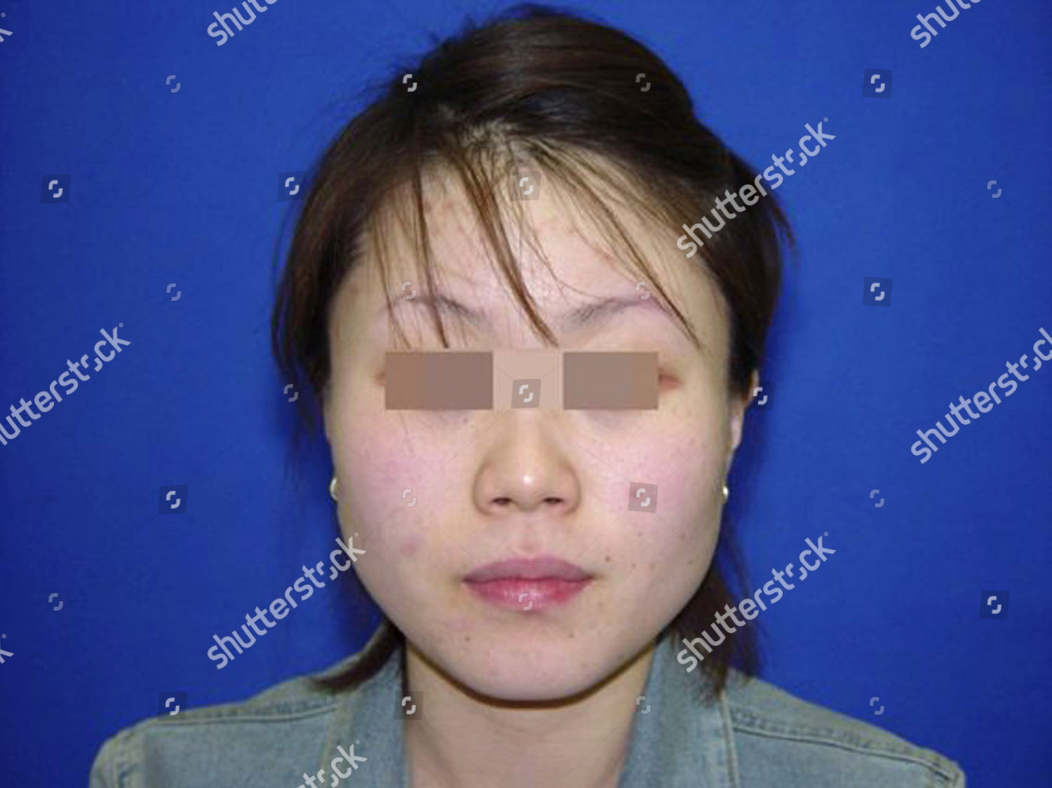 Example Mandible Angle Reduction Jaw Reconstruction Editorial Stock ...