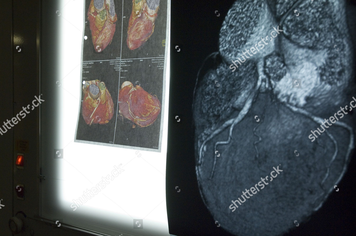 3d Radiographs On Lightbox Editorial Stock Photo - Stock Image ...