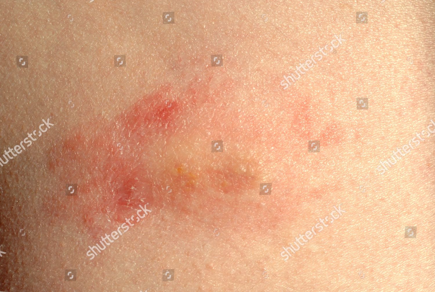 Close Skin Blemish Blisters Shingles Herpes Editorial Stock Photo ...
