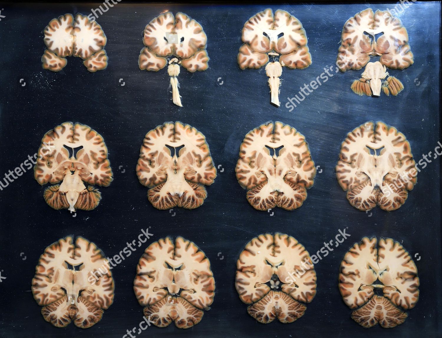 Plastinate Cross Sections Through Human Brain Editorial Stock Photo ...