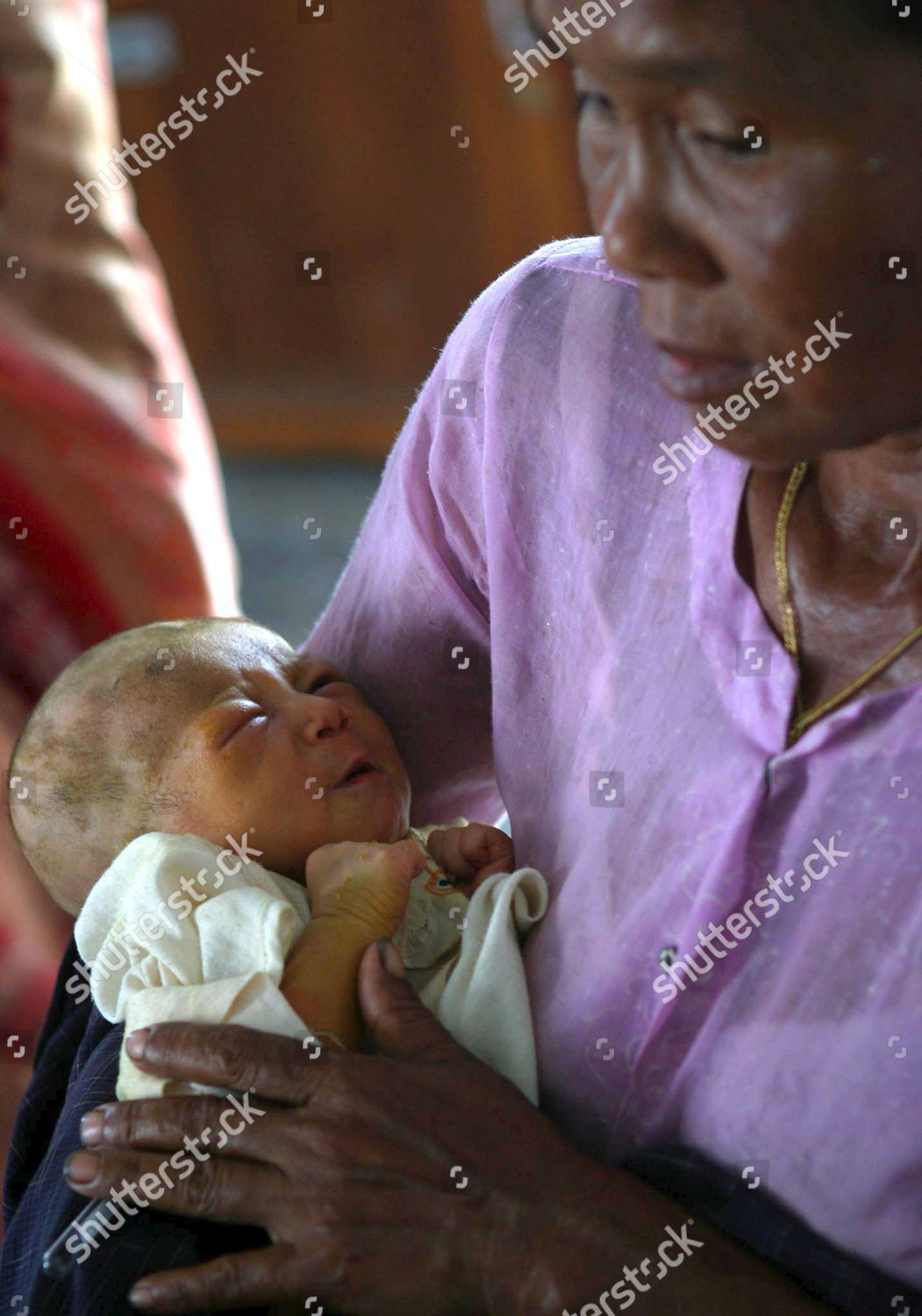 Sick Child Tetanus Treated Small Clinic Editorial Stock Photo - Stock ...