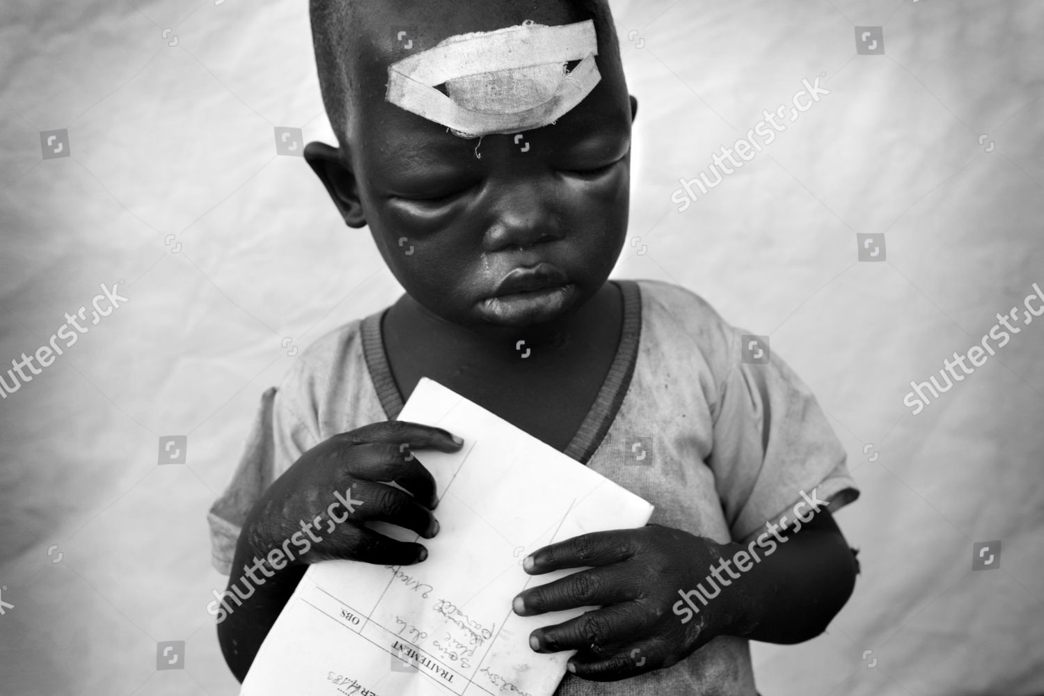 YOUNG BOY SUFFEREING EDEMA CAUSED BY Editorial Stock Photo - Stock ...