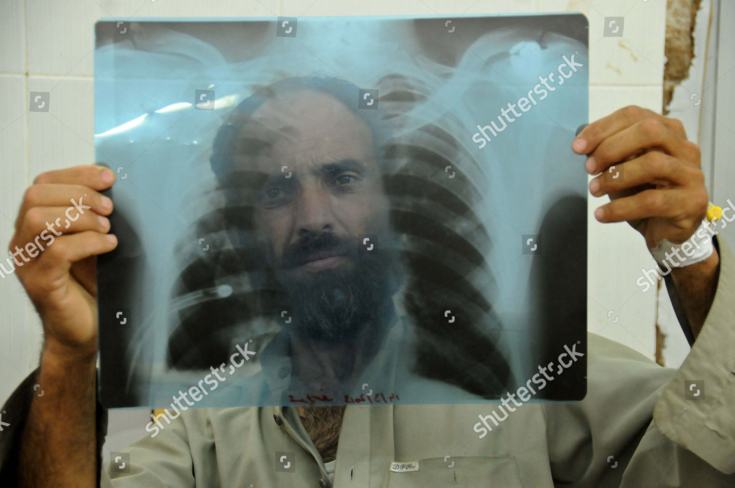 Patient Suffering Tuberculosis Tb Looks His Editorial Stock Photo ...