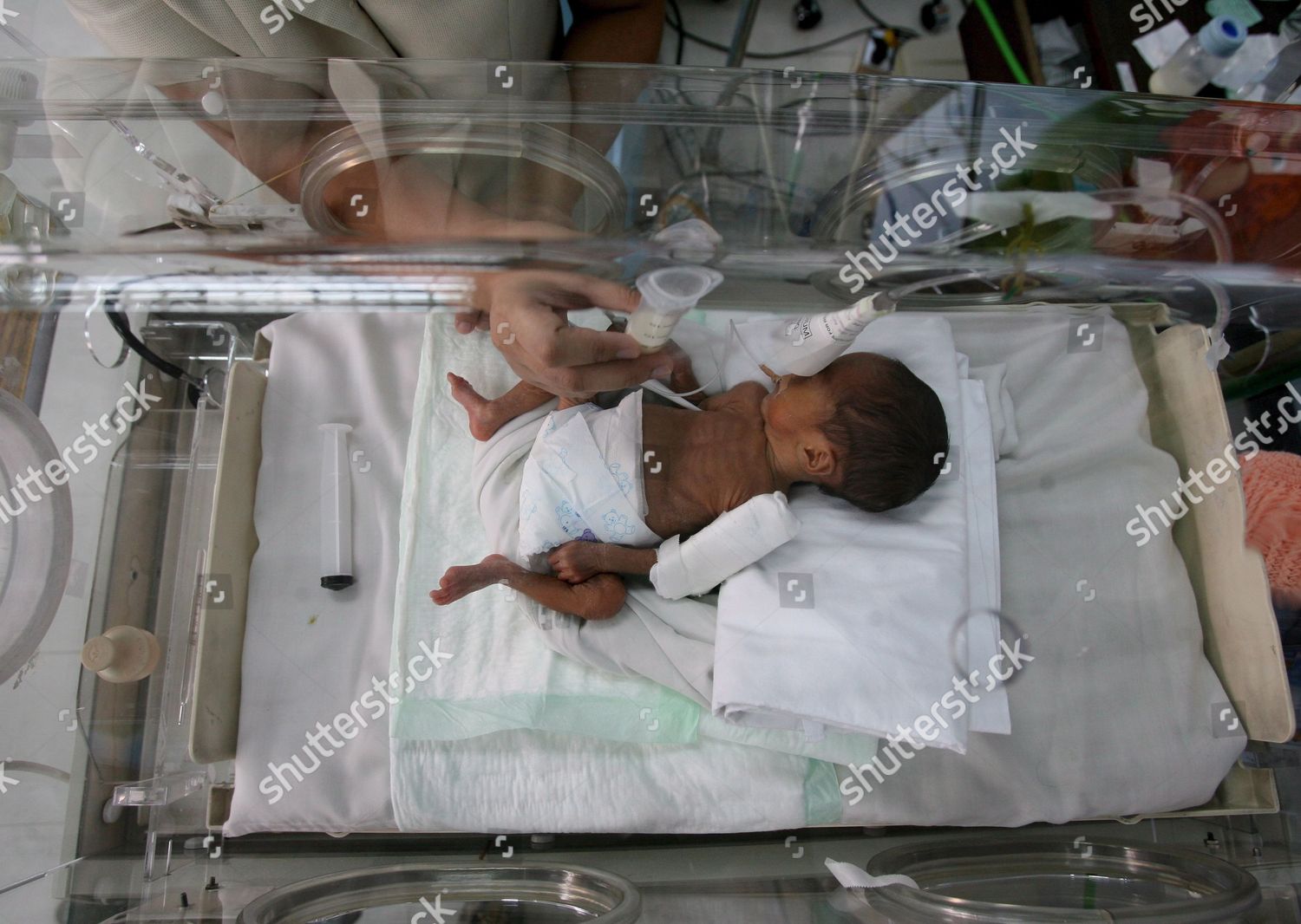 Filipino Infant Born 28 Weeks Premature Editorial Stock Photo - Stock ...