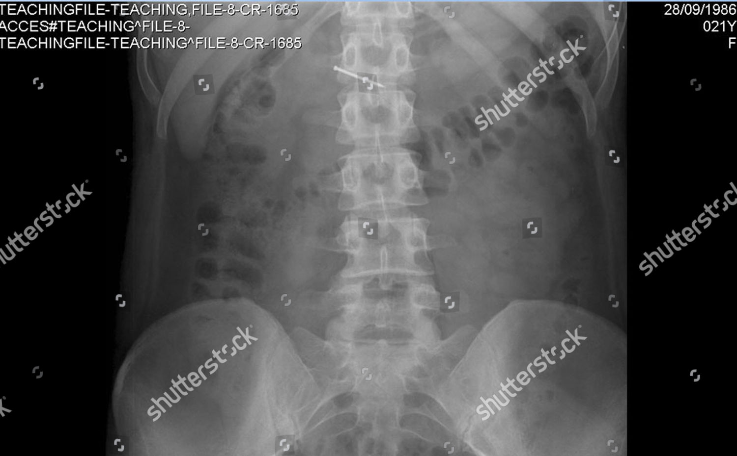 Xray Showing Nail Editorial Stock Photo - Stock Image | Shutterstock