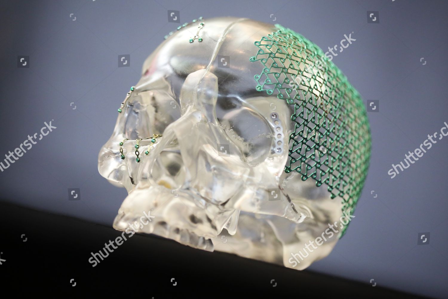 Skull Model Titanium Mesh Implant Presented Editorial Stock Photo ...