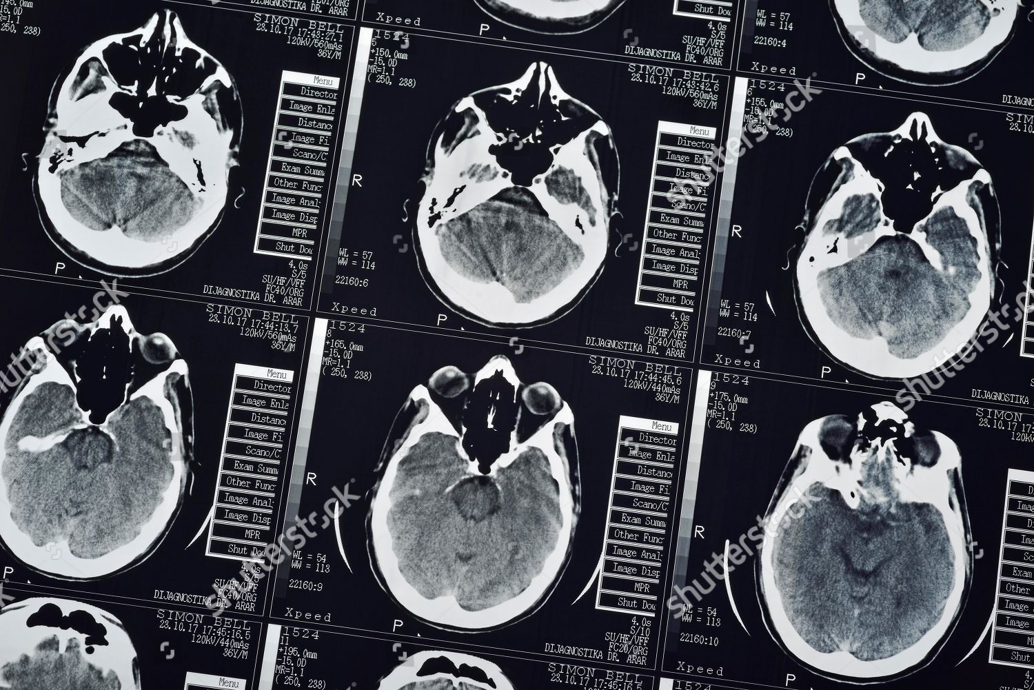 Ct Scan Human Male Brain Close Editorial Stock Photo - Stock Image ...